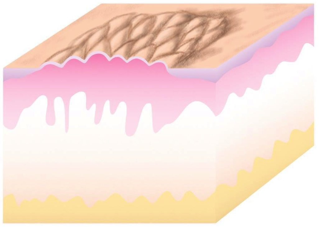 Lesiones elementales – Manual Digital de Dermatología